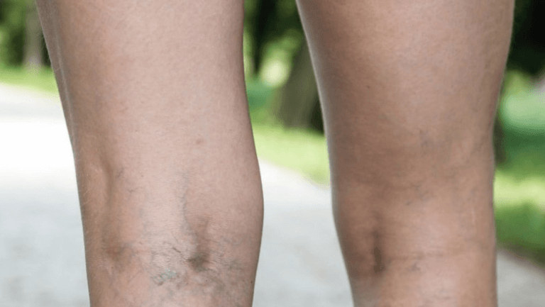 O que problemas circulatórios causam em idosos? - Acvida Cuidadores